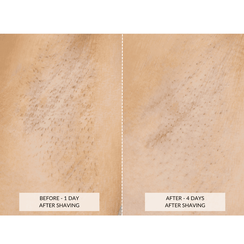 Laser Hair Removal Device | At Home Laser Hair Removal Machine ...